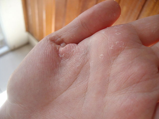 Dermatitis en las manos: síntomas, causas y tratamiento - Tua Saúde