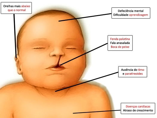 Sindrome De Digeorge DiGeorge Syndrome: Pathogenesis And Clinical