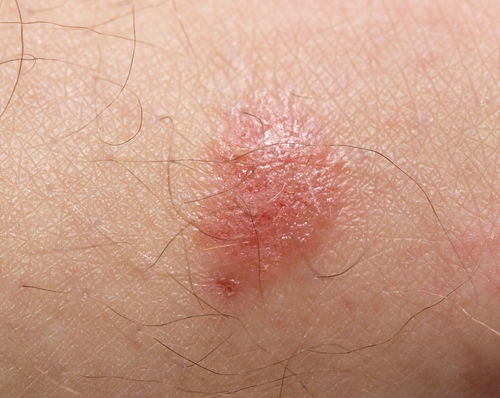 Hongo en la ingle: síntomas, causas y tratamiento - Tua Saúde