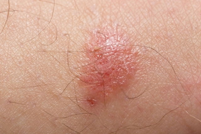 Hongo en la ingle: síntomas, causas y tratamiento - Tua Saúde