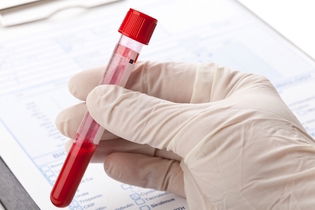 AST Blood Test: Normal Levels (& What High Levels Means) - Tua Saúde