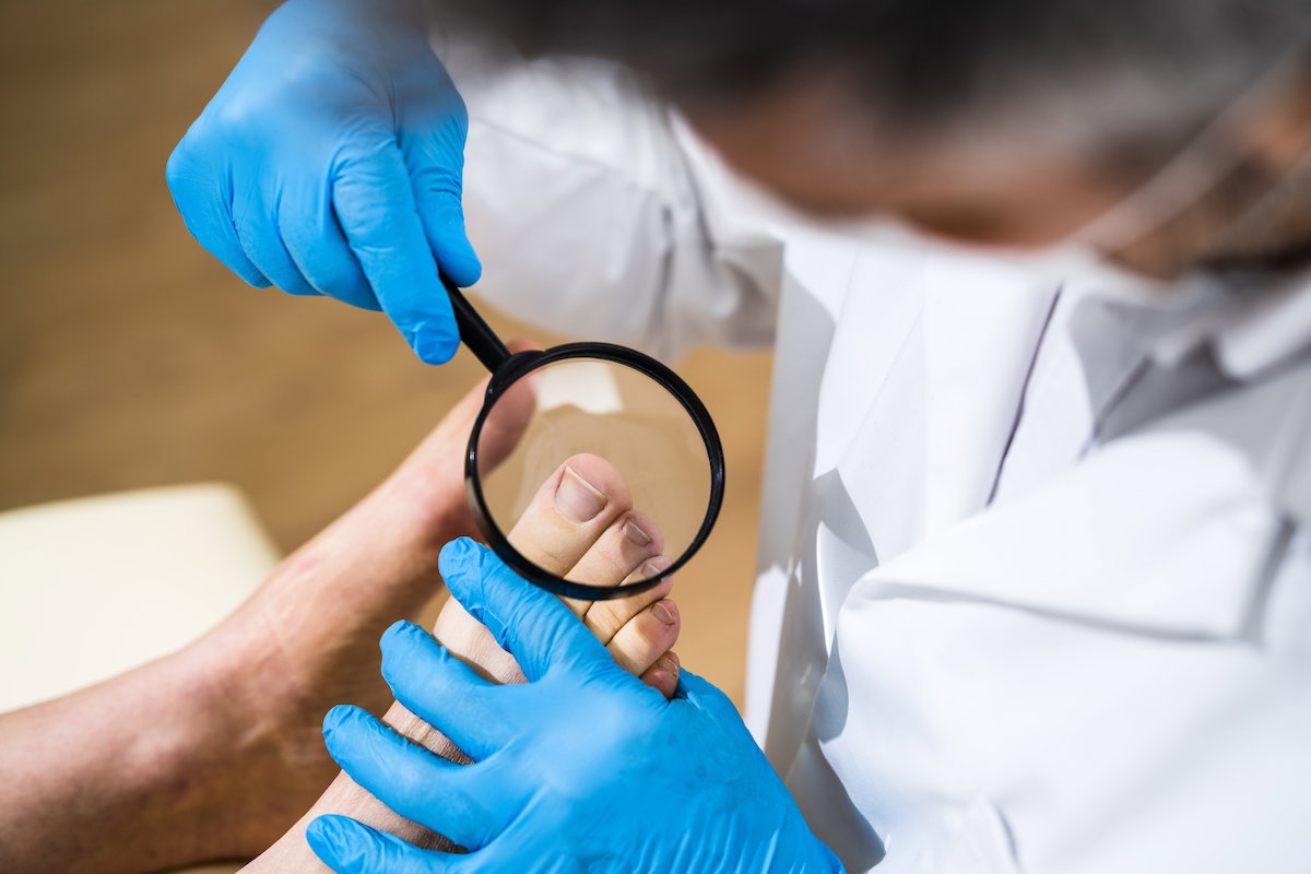 Ingrown Fingernail: Symptoms, Diagnosis, Causes & Treatment - Tua Saúde