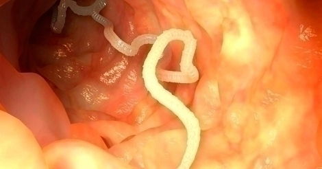 10 symptômes de vers intestinaux - Tua Saúde