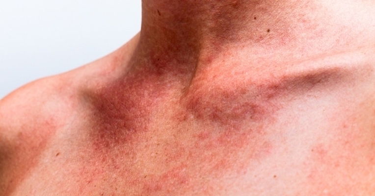 Tratamento para urticária: 6 principais opções - Tua Saúde