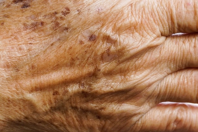 Skin Blemishes: 9 Common Types & Treatment - Tua Saúde