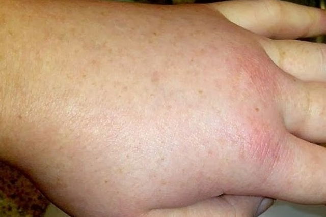 Angioedema: o que é, sintomas, causas e tratamento - Tua Saúde