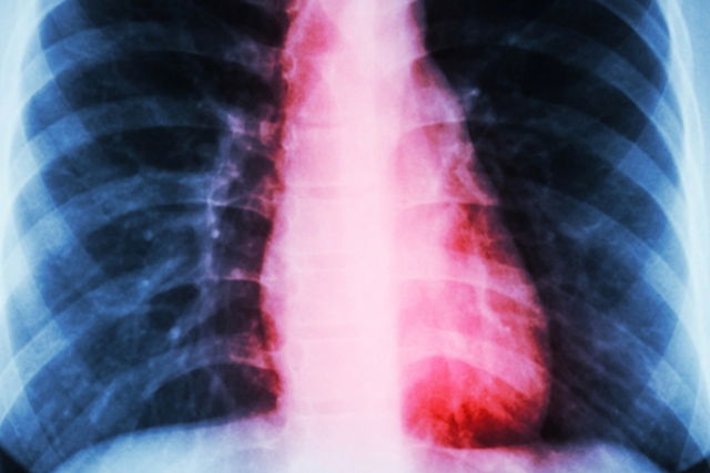 Miocarditis: qué es, síntomas y tratamiento - Tua Saúde