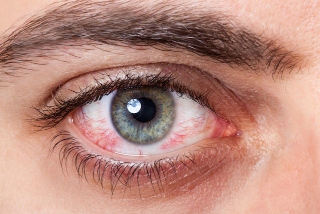 7 alteraciones en los ojos más comunes - Tua Saúde