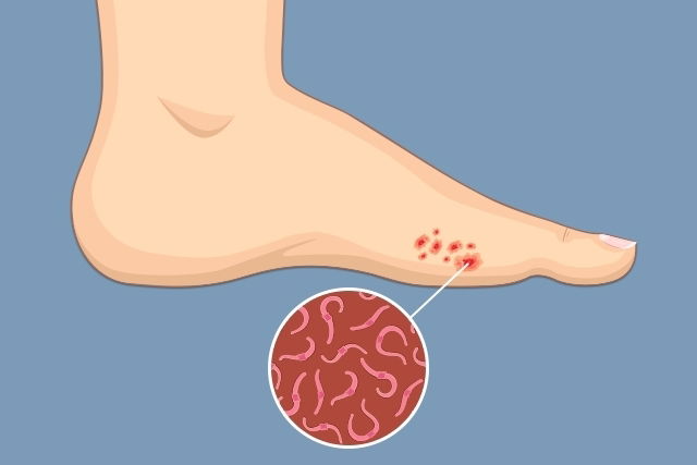Miíase humana: o que é, sintomas, tratamento e prevenção - Tua Saúde