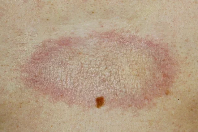 Red Spots On Skin: Symptoms Quiz, Causes, Pictures & Treatment - Tua Saúde