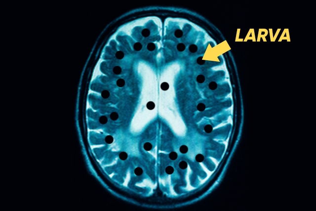 Cisticercose: o que é, sintomas, ciclo de vida e tratamento - Tua Saúde