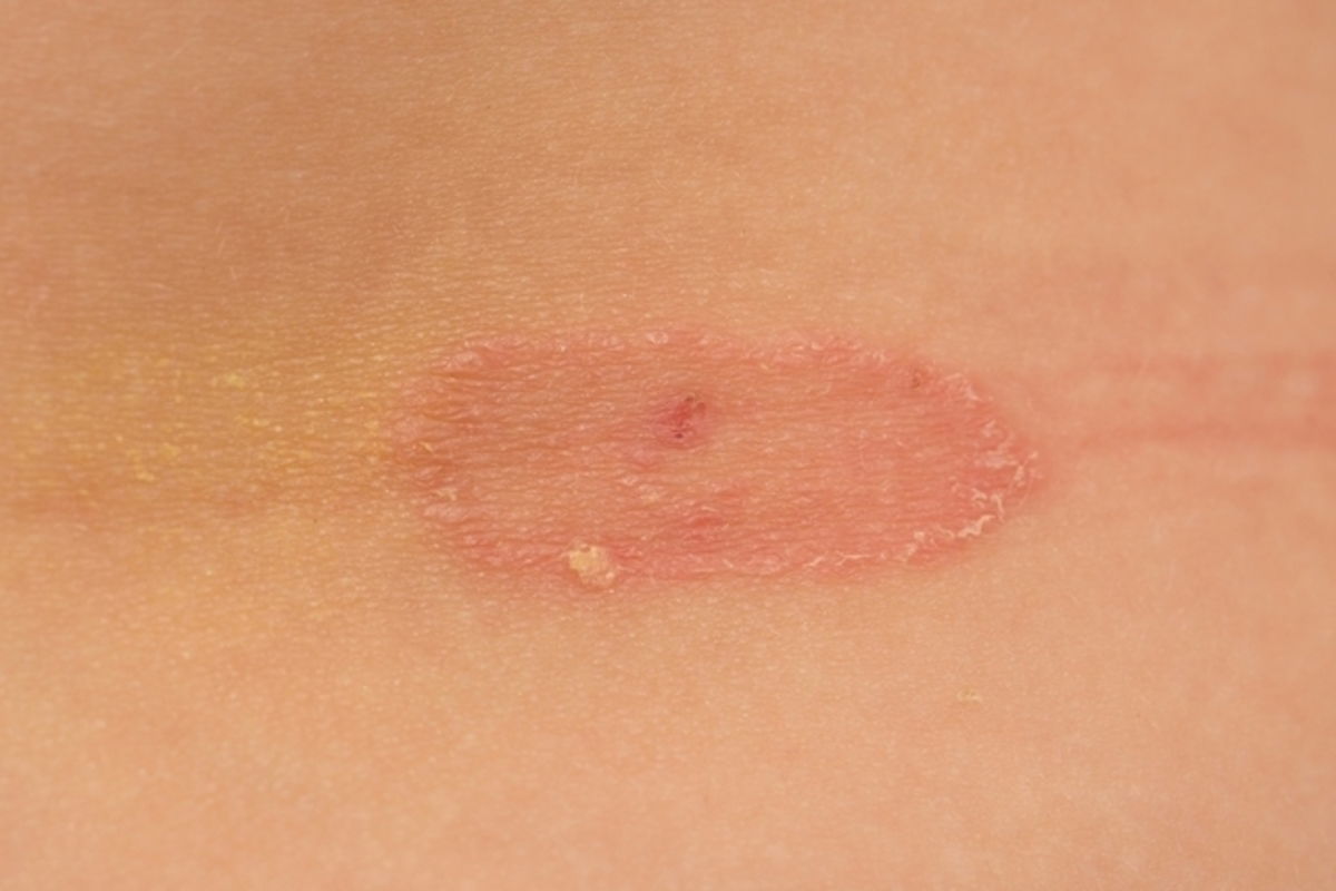 10 enfermedades causadas por hongos (y cómo es el tratamiento) - Tua Saúde