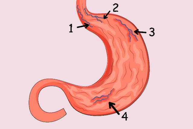 Varizes no estômago: o que são, sintomas, causas e tratamento - Tua Saúde