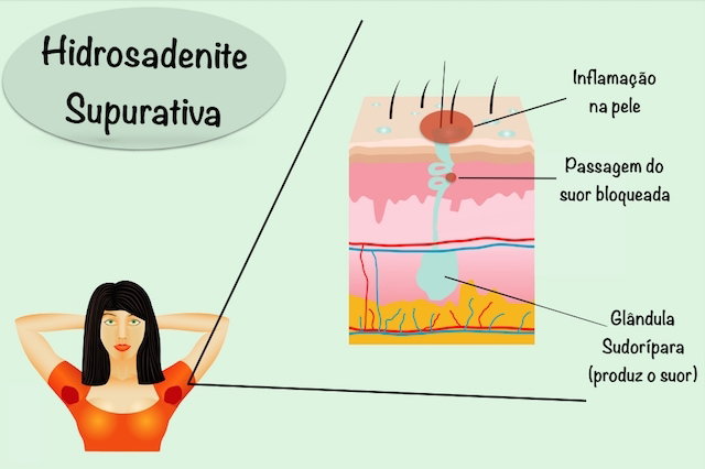 Hidradenite Supurativa Axilar