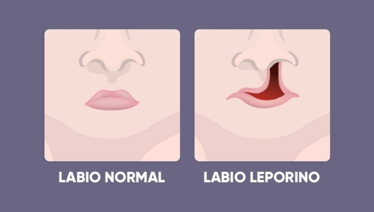 Lábio leporino: qué es, causas y tratamiento - Tua Saúde