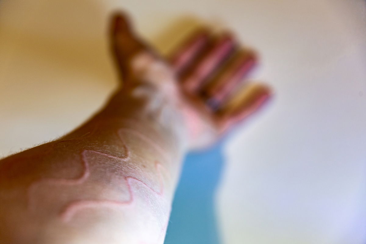 Dermografismo: o que é, sintomas, causas e tratamento - Tua Saúde