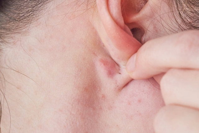 Bulto O Bolita Detrás De La Oreja 7 Causas Y Qué Hacer Tua Saúde
