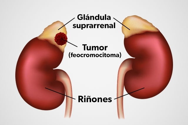 Feocromocitoma: qué es, síntomas y tratamiento - Tua Saúde