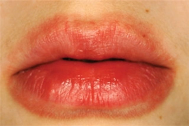 Swollen Red P On Bottom Lip - Infoupdate.org