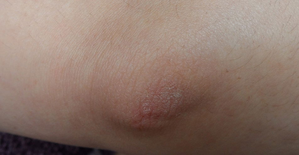 Pilonidal Cyst: Symptoms, Causes, Treatment & Wound Care - Tua Saúde