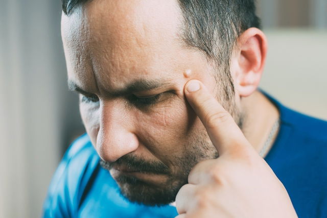Kyste sébacé: symptômes, causes et traitement - Tua Saúde