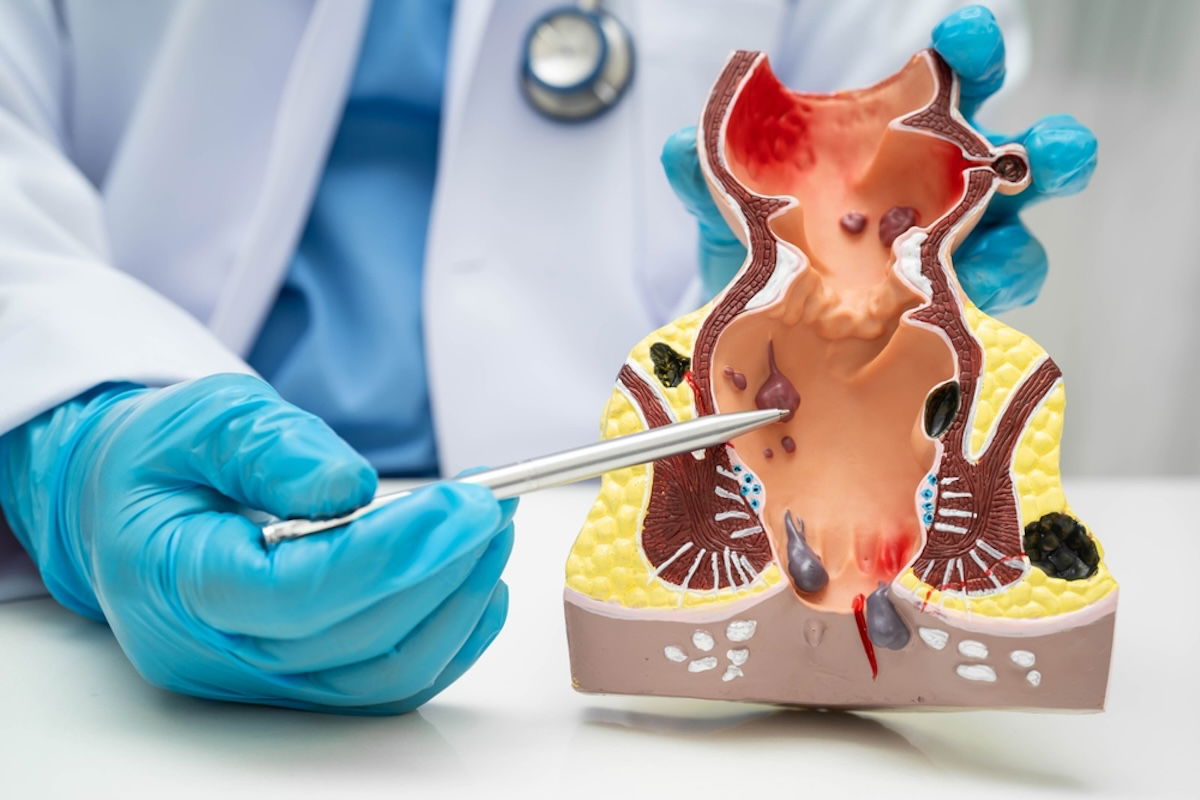 Hemorroides internas: qué son, síntomas, grados y tratamiento - Tua Saúde