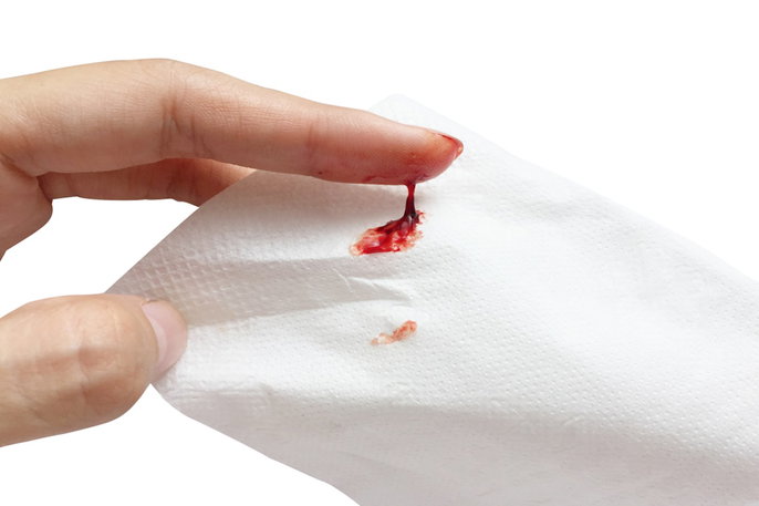 Mocos con sangre: 10 causas y qué hacer - Tua Saúde