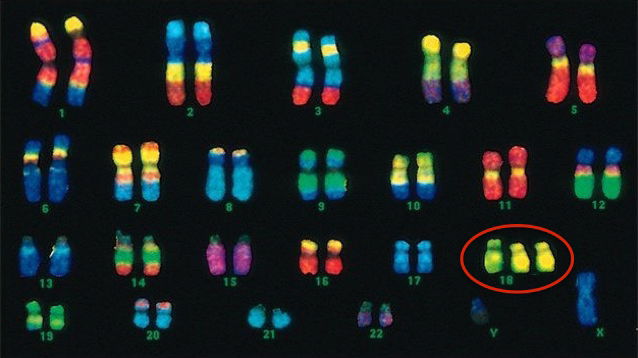 Síndrome de Edwards: o que é, características, causas e tratamento ...