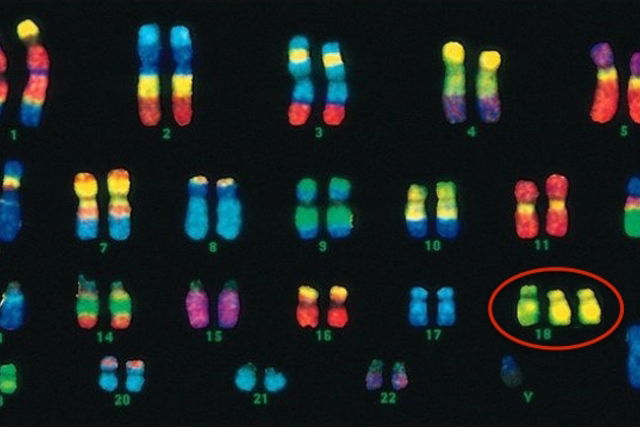 Síndrome de Edwards: o que é, características, causas e tratamento ...