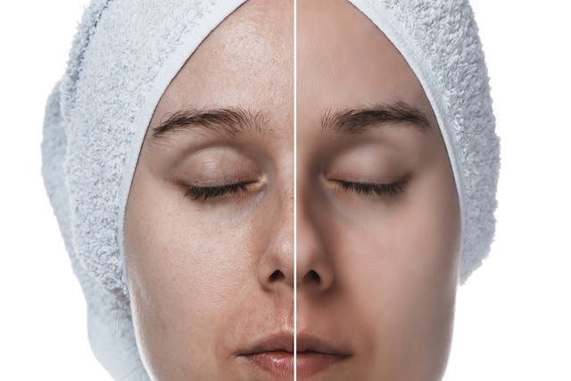 Carboxiterapia Para Olheiras Como Funciona E Cuidados Necessários